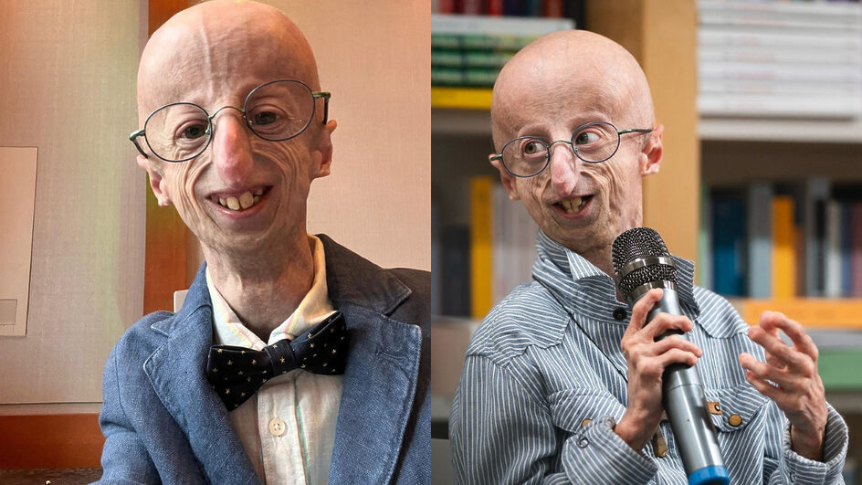 Morre Sammy Basso, o italiano que lutou contra a progéria até os 28 ...