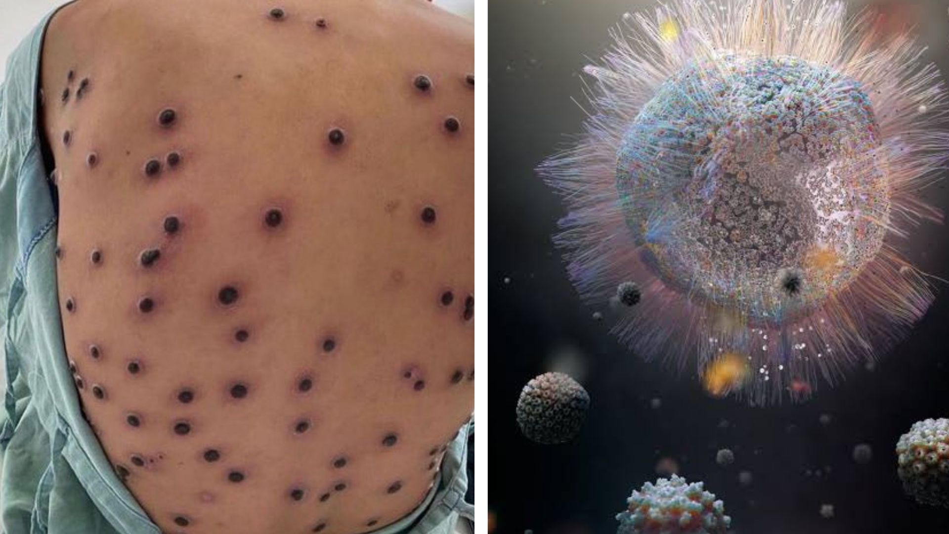 Primeiro caso da nova cepa de Mpox é confirmado no Brasil; veja vídeo ...